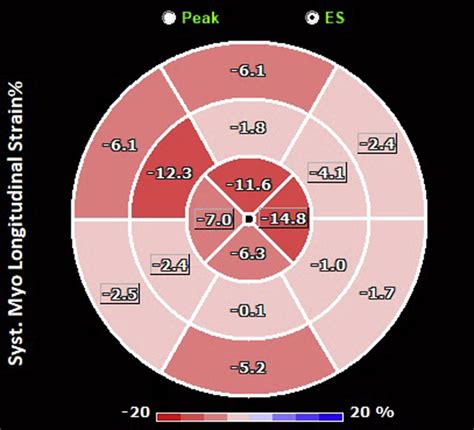 An Autopsy Case Of Cardiac Amyloidosis With Heterogeneous Deposition Of