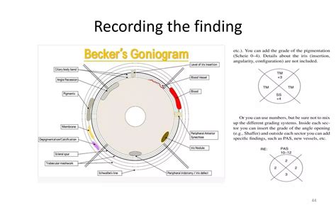 Glaucoma Modified Pptx
