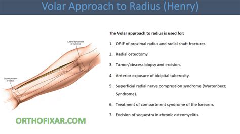 Volar Approach To Radius Easy Tutorial Orthofixar 2026