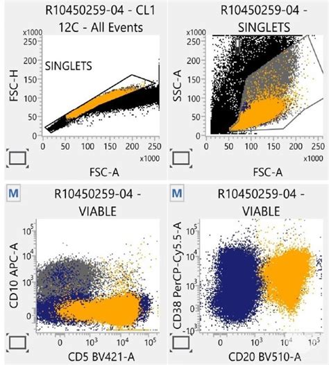 Flowcytometry Findings Cd5 Cd20 Positive And Cd10 Negative