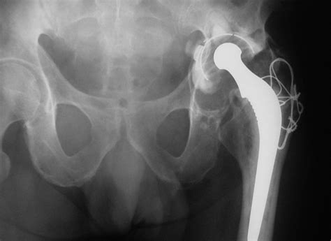 A Stemmed Acetabular Component In The Management Of Severe Acetabular