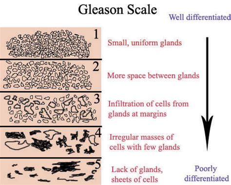 Science Doing Benign Prostatic Hyperplasia Could Be Adenocarcinoma
