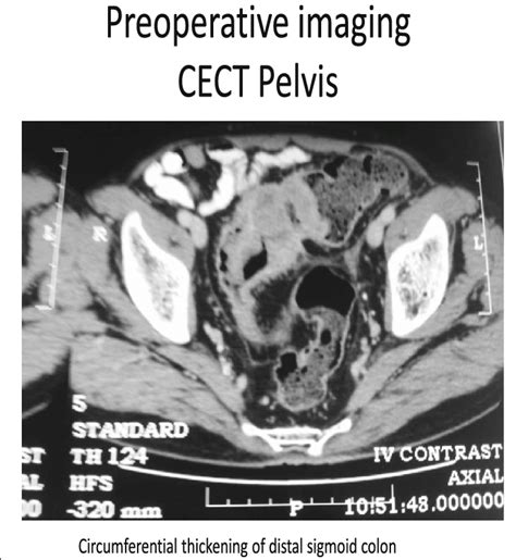 Circumferential Thickening Of Sigmoid Colon On Contrastenhanced
