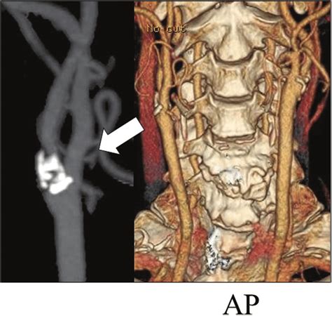 Case 1 Stenosis And Calcification Of The Right Ica On 3d Cta Arrow Download Scientific
