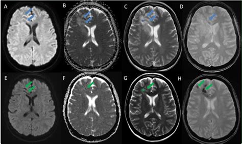 Figure 1 From Listeria Monocytogenes Brain Abscesses In A Patient With