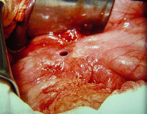 Duodenum Surgery Photos