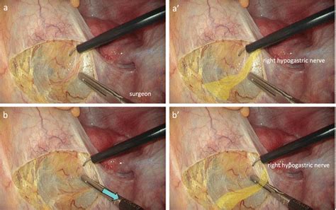 Laparoscopic Left Sided Colectomy Mobilization Of Splenic Flexure And