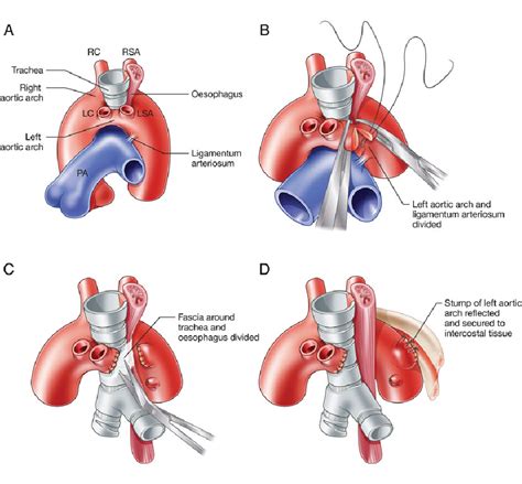 What Is Vascular Ring Surgery At Virginia Nealon Blog