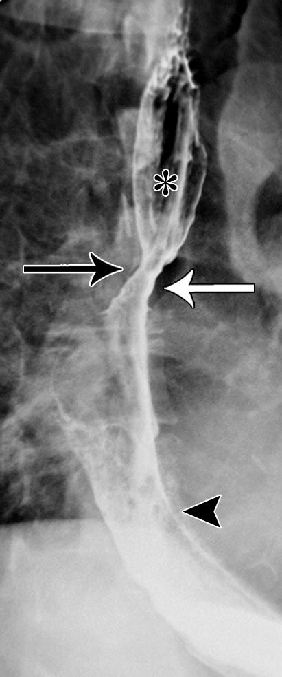 Esophagectomy And Gastric Pull Through Procedures Surgical Techniques