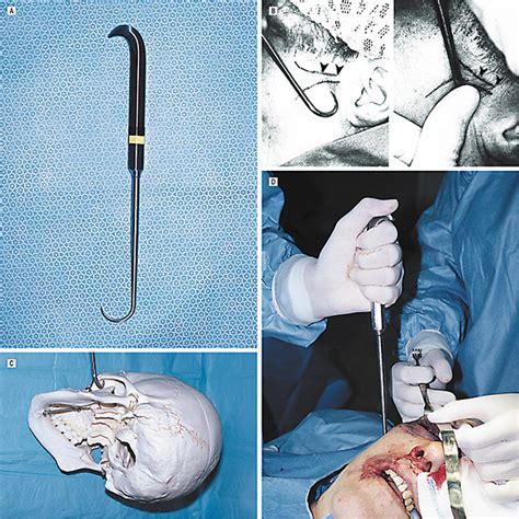 Zygomatic Complex Fracture Surgery