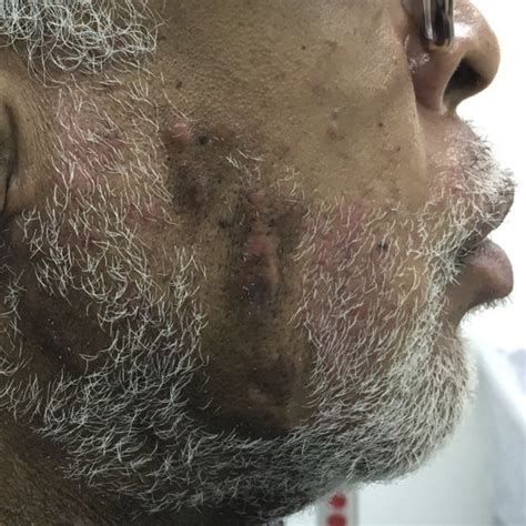 Fully Epithelialized Wound 2 Weeks After Skin Grafting Download