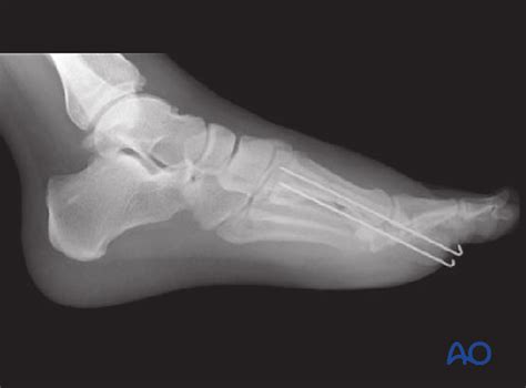 Intramedullary K Wire Fixation For Simple Diaphyseal And Proximal Extraarticular Fractures Of