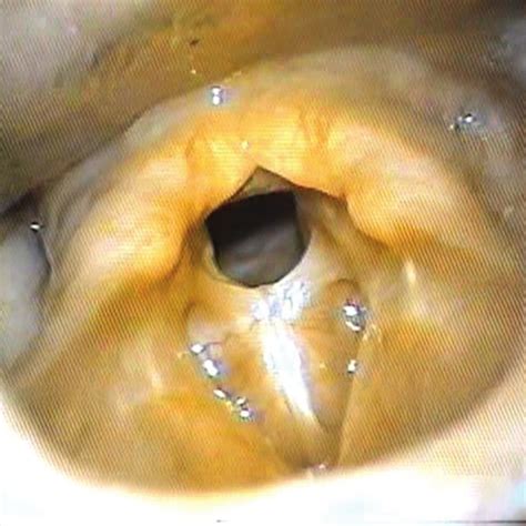 Laringite Crônica Videolaringoscopia Mostrando Hiperemia E Edema Das