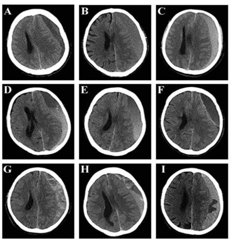 The Classification Of Csdh According To The Hematoma Density On Ct