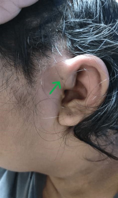 Mycobacterial Preauricular Sinus Abscess A Case Series Pmc