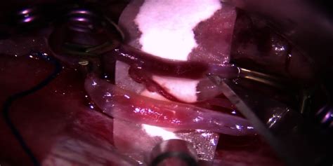 In Situ Left Azygous Anterior Cerebral Artery To Right Peric