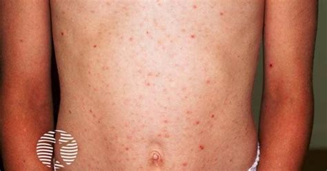 Pityriasis Lichenoides Image