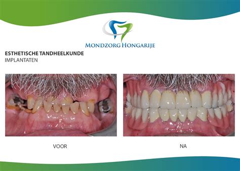 Implantaten Mondzorg Hongarije