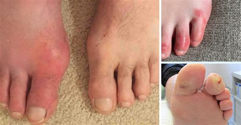 6 Doenças Que Mostram Sintomas Pelos Pés