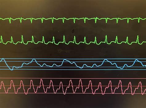 Anyone Know What Causes An Arterial Waveform Like This Its “backwards”…the Dicrotic Notch Is