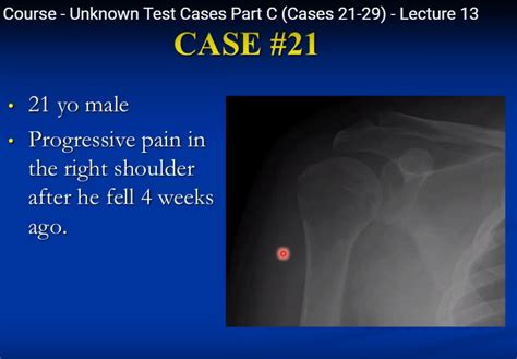 Ewing Sarcoma Oncology Medbullets Step 23