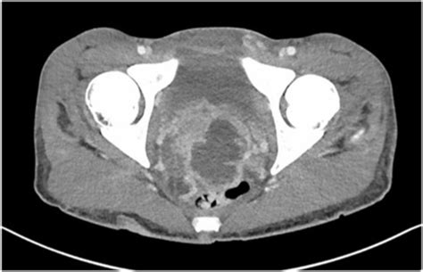 Disseminated Blastomycosis Presenting With Genitourinary Abscesses Pmc