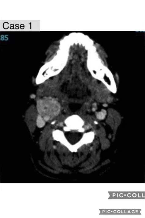 Borja Castejon On Linkedin Sanitas Sanitashospitales Endovascular Vascular Paraganglioma…