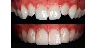 Carillas Inyectadas Una Excelente Alternativa Para La Estética Dental