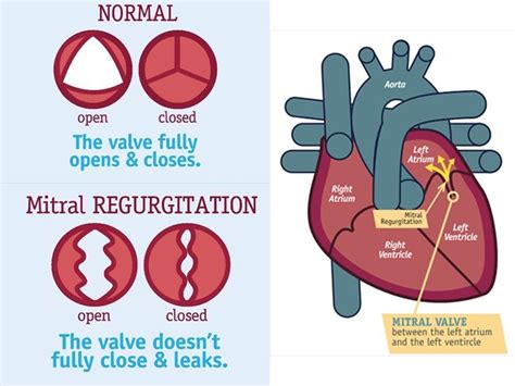 Structural Heart Programme Tavi Mitraclip Cvskl