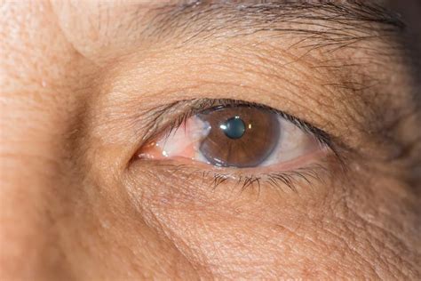 What Is Pterygium And How Do I Treat It
