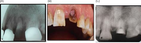 Figure 1 From Ferrule Effect And Its Importance In Restorative Dentistry A Literature Review