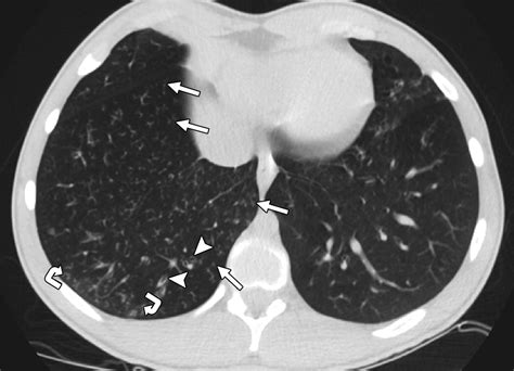 Imaging Of Cystic Fibrosis And Pediatric Bronchiectasis Ajr
