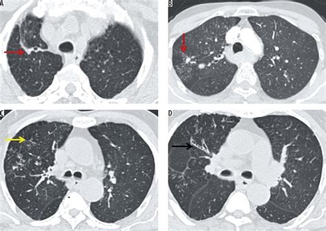 Aftermath Of Pulmonary Tuberculosis Computed Tomography Assessment Pmc