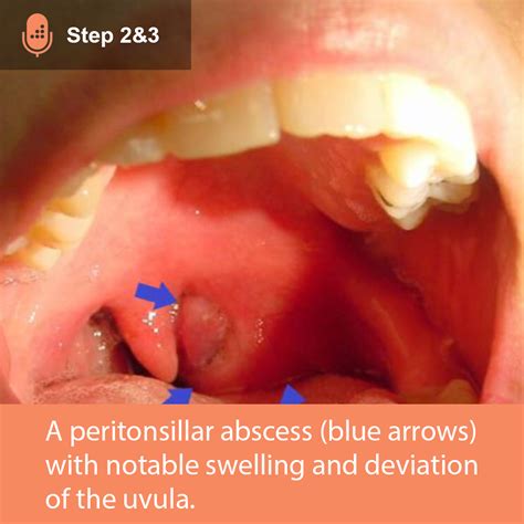 Peritonsillar Abscess Incision And Drainage