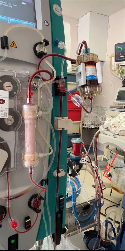Cytokine Ha60 Sepsis Ecmo Ismail Yerlİ