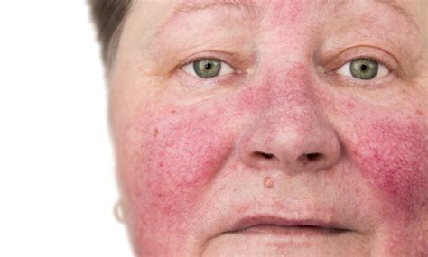 Fields Disease Hastalığı Belirtileri Sebepleri Tedavi Yöntemleri