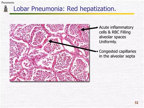 Pathology Of Pneumonia Pptx