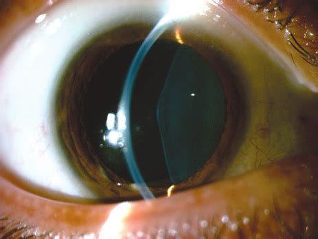 Anterior Lenticonus In Od Before Cataract Surgery Download