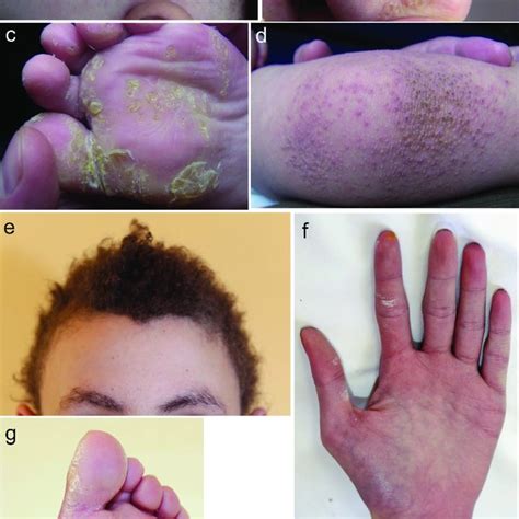 Pdf Desmoplakin Mutations With Palmoplantar Keratoderma Woolly Hair And Cardiomyopathy