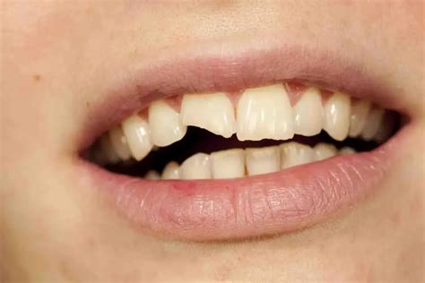 What Is A Cuspid Tooth Location Function And Care