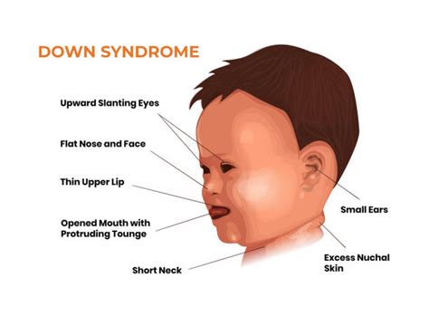 Down Syndrome Guide Repc