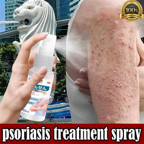 Psoriasis Spray 60ml Is Suitable For Itchy Skin Dermatitis And Eczema