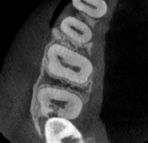 External Root Resorption Is Intentional Replantation A Real Option A