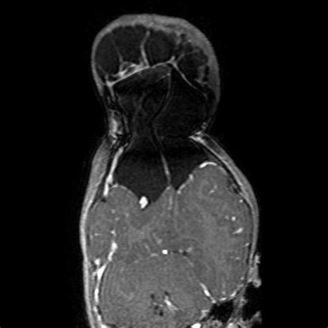Encephalocele Pacs