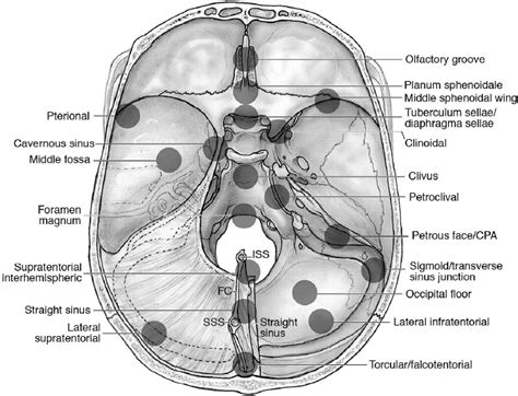 What Is Planum Sphenoidale Meningioma