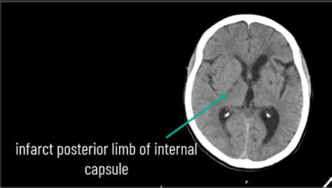 Hypodense And Hyperdense In Ct Ct Scan And Mri
