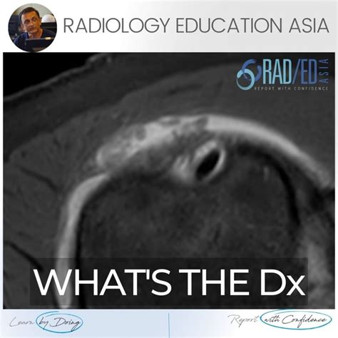 Subacromial Subdeltoid Bursitis Mri Radiology Video Radedasia