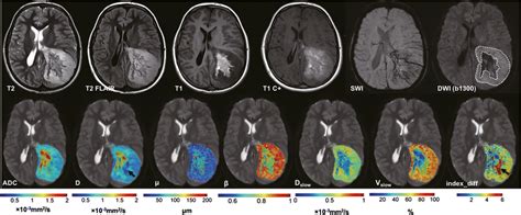 Parametric Maps Of Multiple Diffusion Parameters Overlaid On The Dw