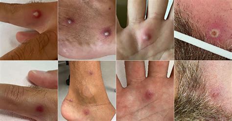 Serious Amdk Had Holiday Gay Sex Contracted Covid 19 Hiv And