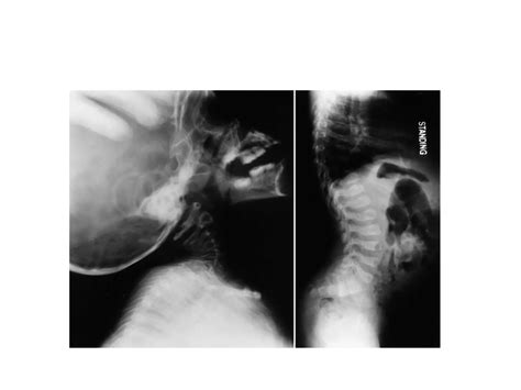 Achondroplasia Hypochondroplasia And Spondyloepiphyseal Dysplasia Pptx